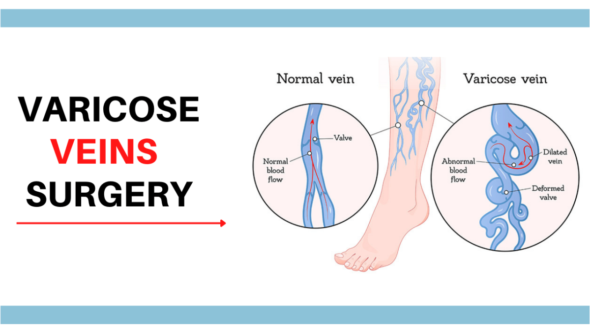 Varicose Veins Surgery | #1 | Star Hospital