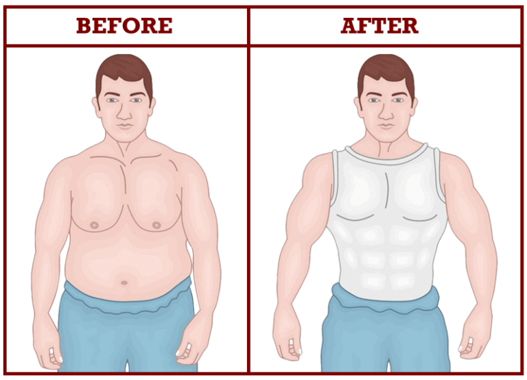 Gynaecomastia Surgery In Jalandhar- Male Breast Reduction Surgery in ...